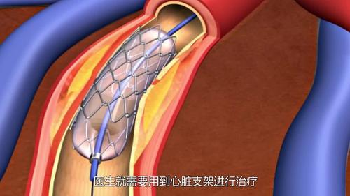 心脏支架是怎么工作的?插入内部把血管撑开,3D动画演示全过程