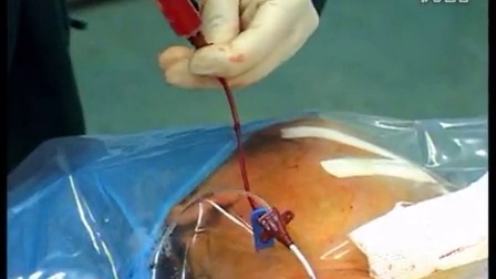 有创测压视频b置管