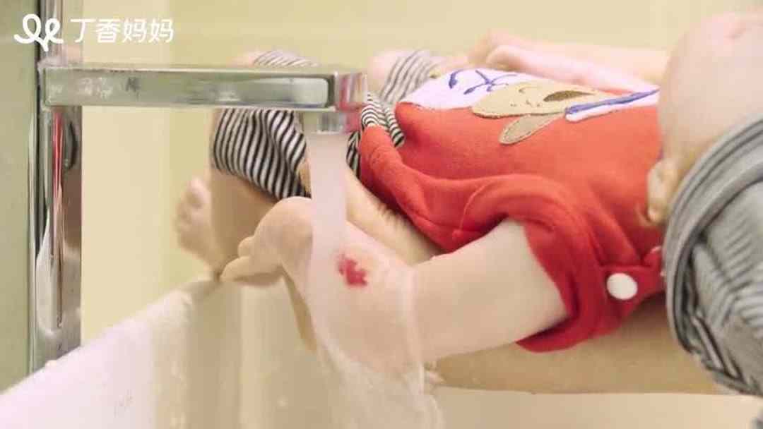 宝宝外伤出血怎么处理