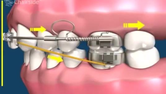 牙齿情况不同矫正方法也不一样,最全面正畸过程!