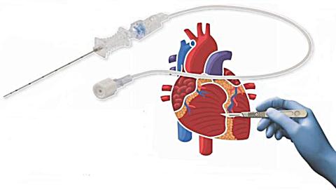 急性心肌梗死、冠心病就一定要介入治疗(PCI)吗?