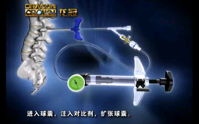 冠龙PKP椎体成形