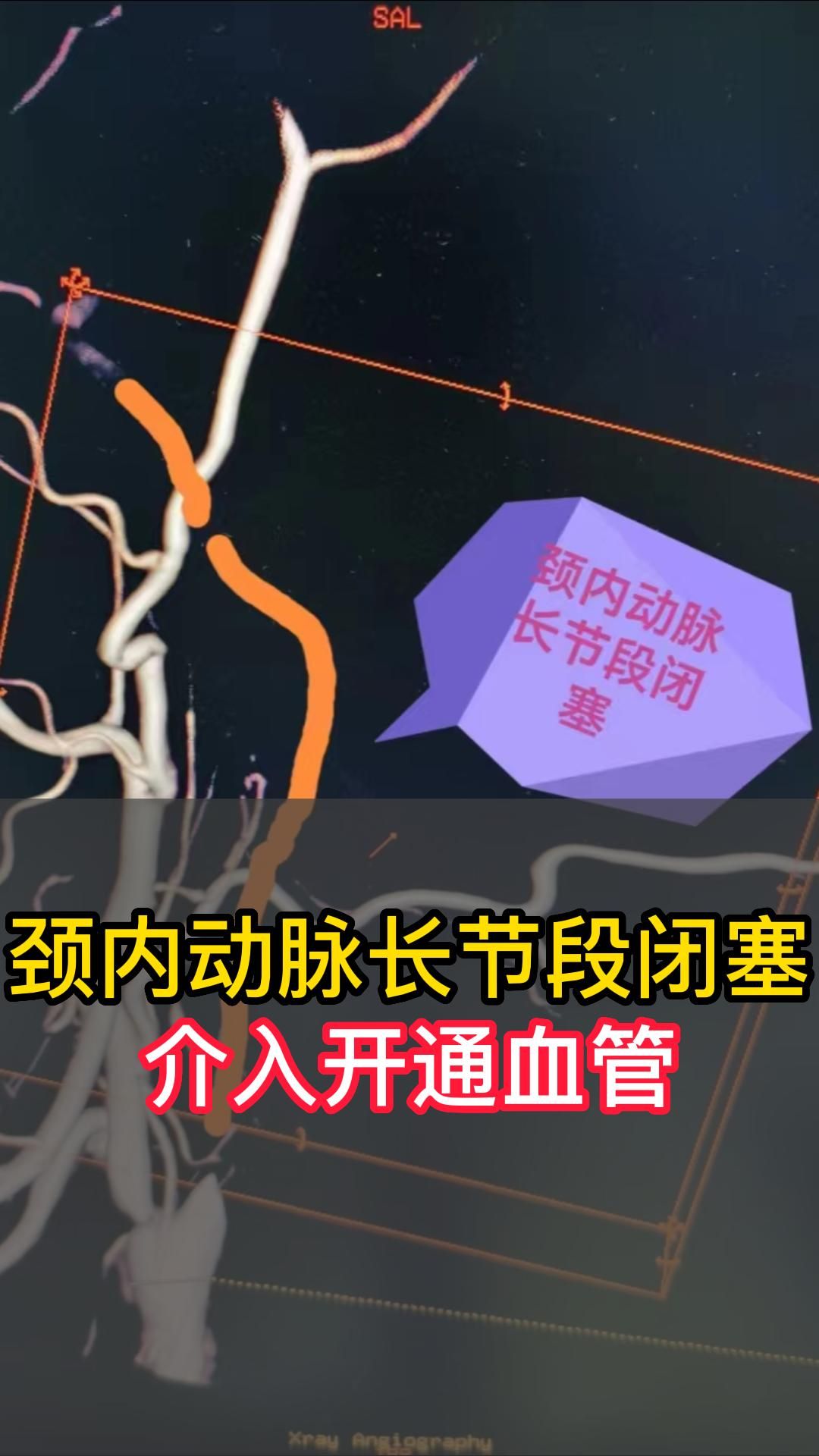 老年男性,脑梗塞,颈内动脉长节段慢性闭塞,介入血管开通。