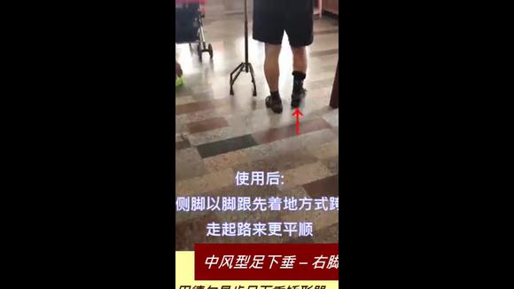 中风多年的患者以易步足下垂矫形器改善步态