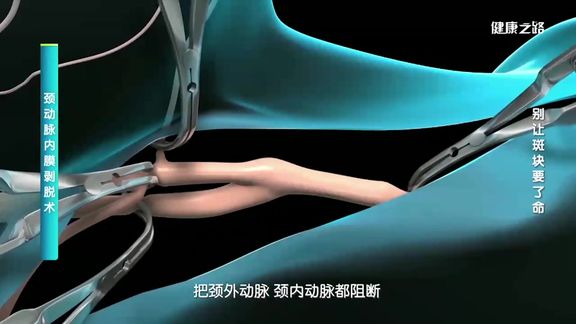 颈动脉斑块的治疗方法