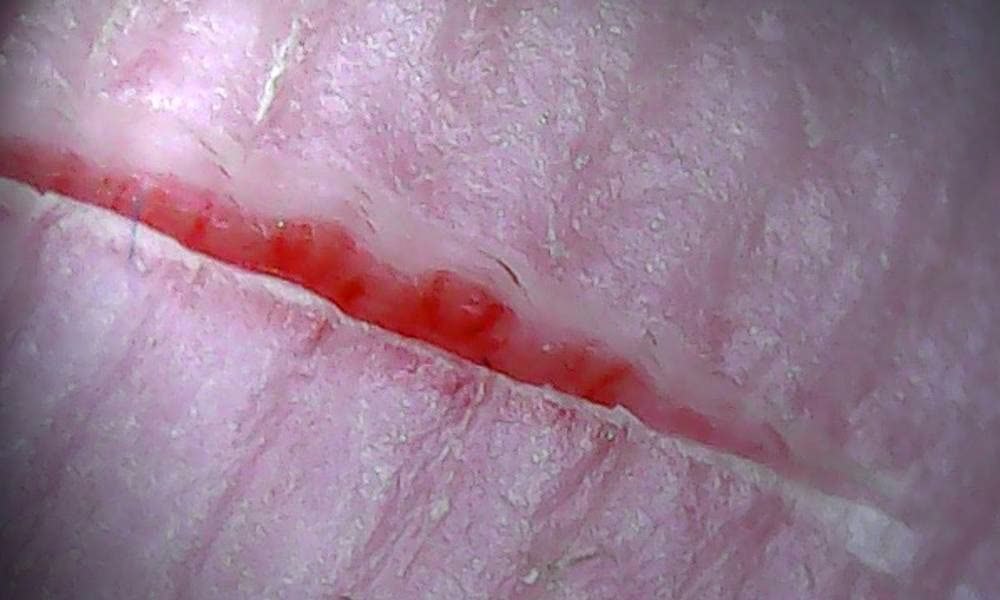 人体受伤后伤口是怎样愈合的?动画模拟全过程,场面一目了然!