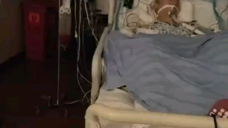 2018年11月21日因为先天性脑血管畸形导致的血管瘤破裂脑出血100ml...