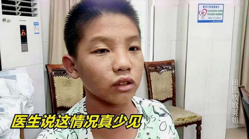 蚂蚁比马蜂还毒,10岁小孩被咬一口肿成这样,医生说这情况少见