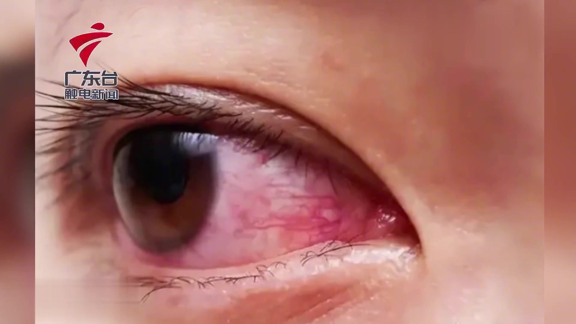 女子戴隐形10年角膜长满新生血管,医生:要合理佩戴和注意卫生