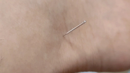 咽喉肿痛,针刺太溪穴,不出5秒咽喉肿痛症状缓解