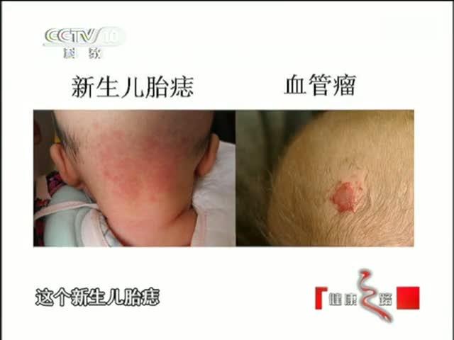 婴儿血管瘤_血管瘤是怎么形成的_血管瘤严重吗