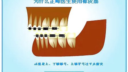 如何使用橡皮筋