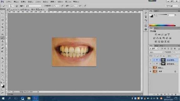 PS大板牙漂白记