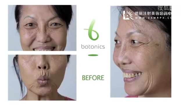 徳丽注射美容培训视频分享注射肉毒杆菌除皱
