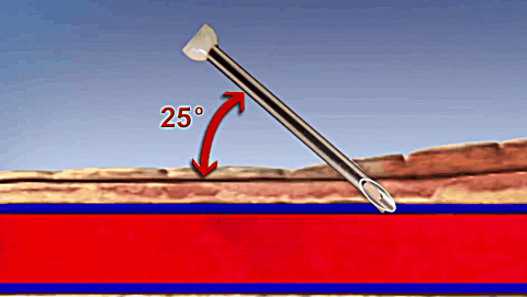 血透病人的动静脉瘘管一年至少被穿刺312次以上, 这技术可以极大减少...