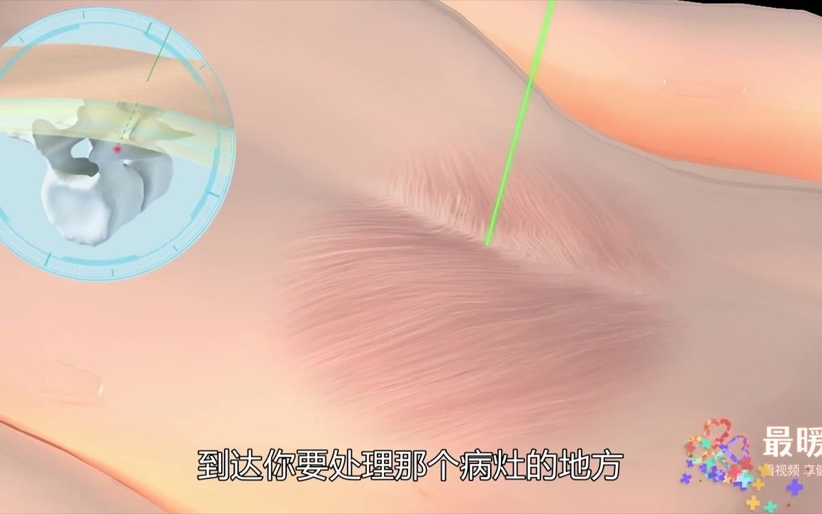 3.激光定位仪临床如何运用