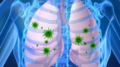 细菌性肺炎和病毒性肺炎,两者有什么区别?