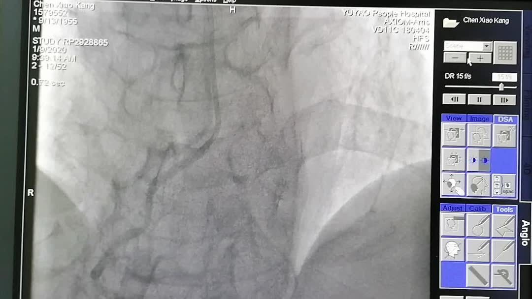 带你近距离了解,正常心脏冠状动脉造影结果,原来是这样的