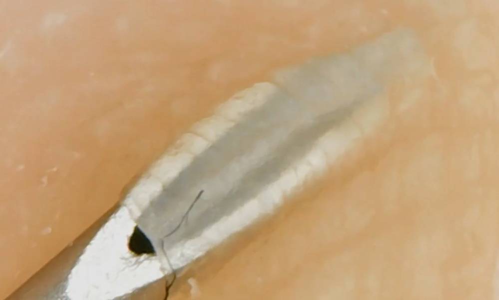 高倍显微镜下看人打针,针管是不规则的,一层层的扎进去!