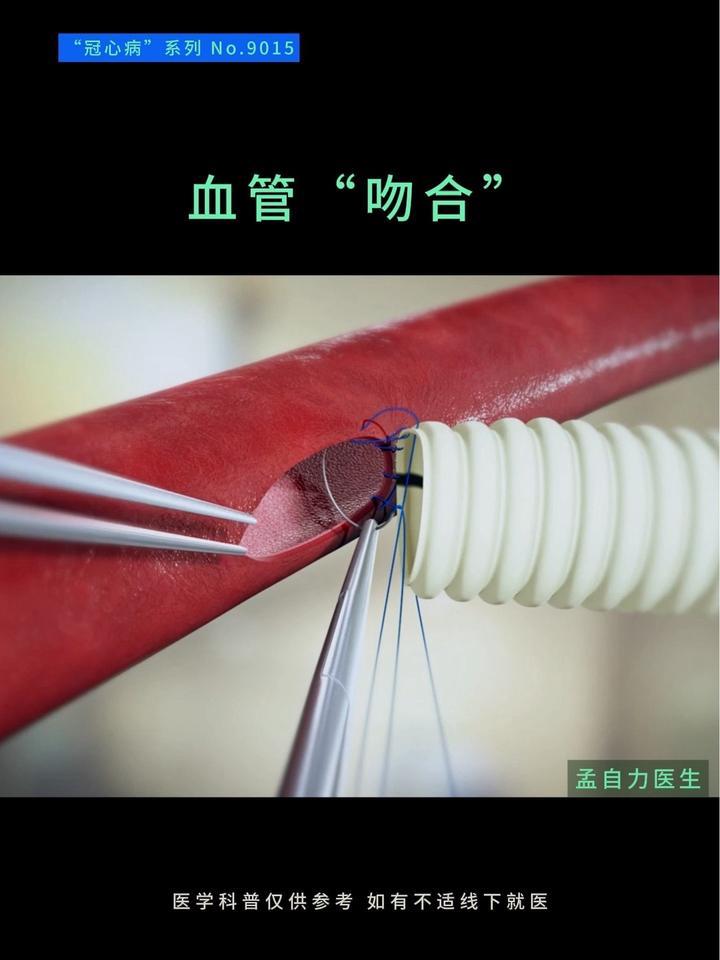 血管吻合过程#冠心病#冠脉搭桥 #冠状动脉旁路移植术 #心脏病@心...