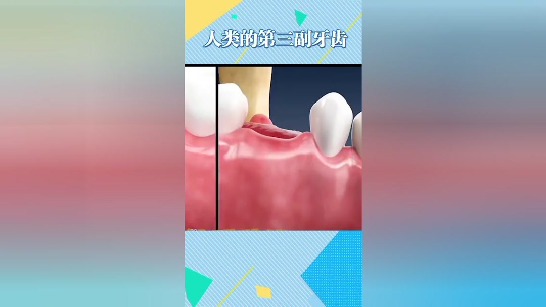 【3D】动画种植牙过程