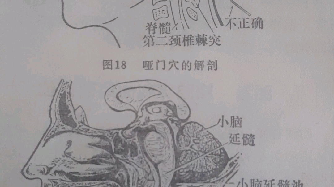 图18哑门穴的解剖图19头颈正中矢状切面
