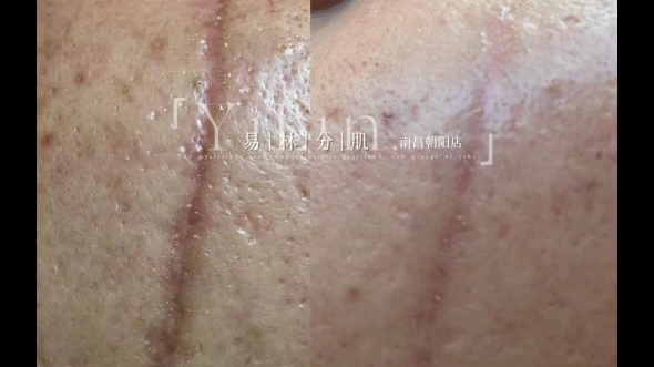 凹陷疤痕修复效果
