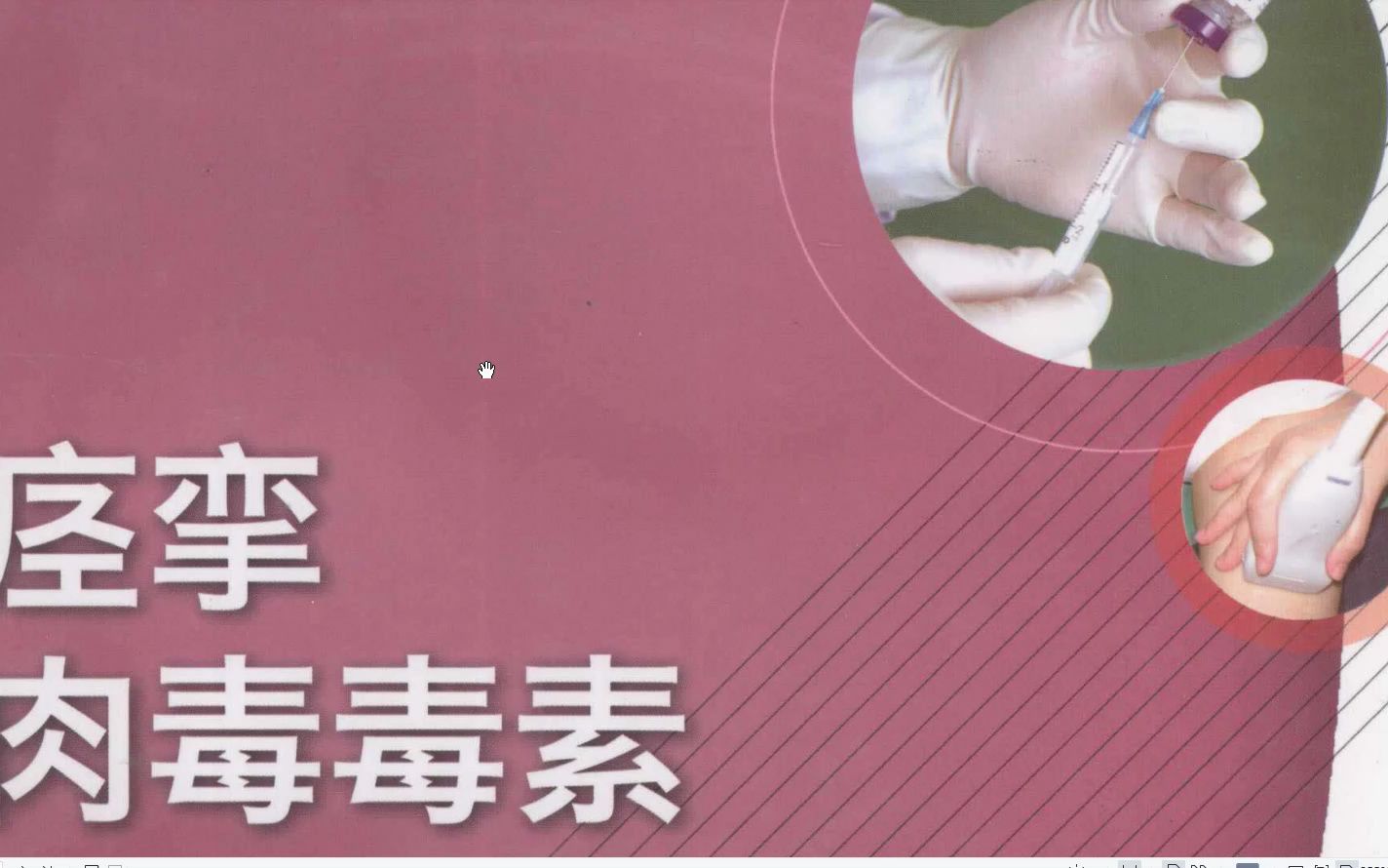 痉挛 肉毒毒素定位注射技术