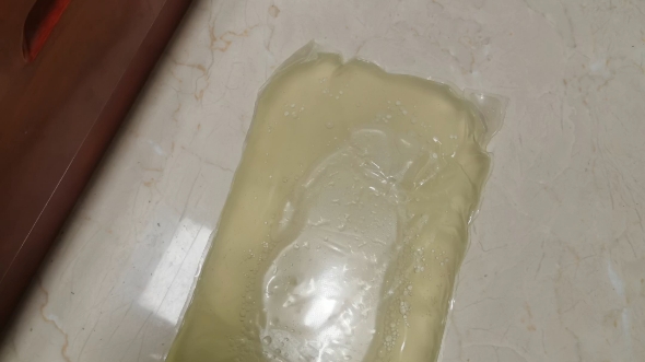 确诊肾衰竭出院后仅过了2个月就因喝了不干净的水感染腹膜炎