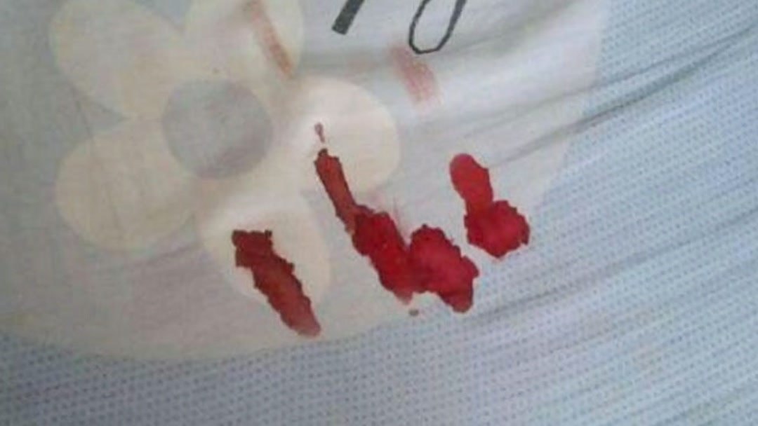 不管床单血渍多顽固,一个方法,新老血渍一洗就掉,不留一点污痕