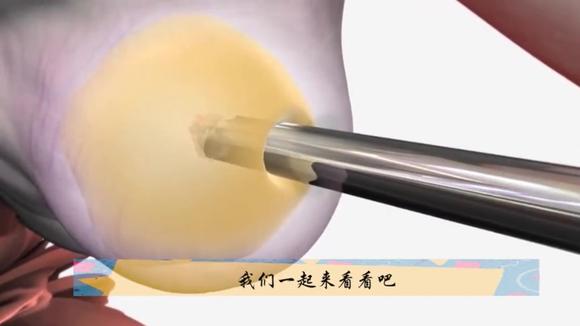 人工授精与试管婴儿有何区别?3D动画模拟全过程,一分钟明了!