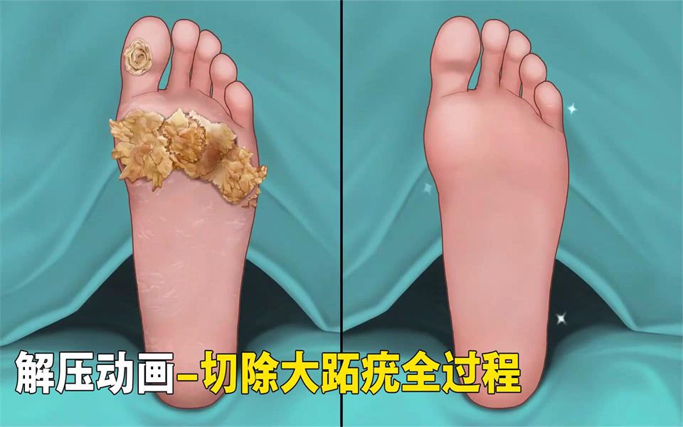 解压动画:沉浸式修脚,第一视角手术切除大跖疣全过程,动画科普