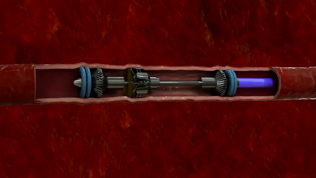 热门片花高清动画演示心梗血管疏通看完就知道为什么手