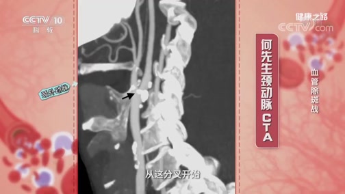 [健康之路]血管除斑战 颈动脉斑块