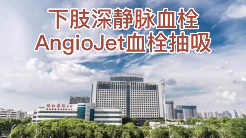 血栓抽吸,局麻下很快静脉血栓从下肢深静脉抽吸到机器引流袋中