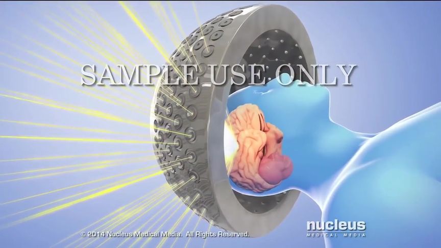 看看颅内肿瘤如何微创治疗,伽马刀治疗脑肿瘤动画演示