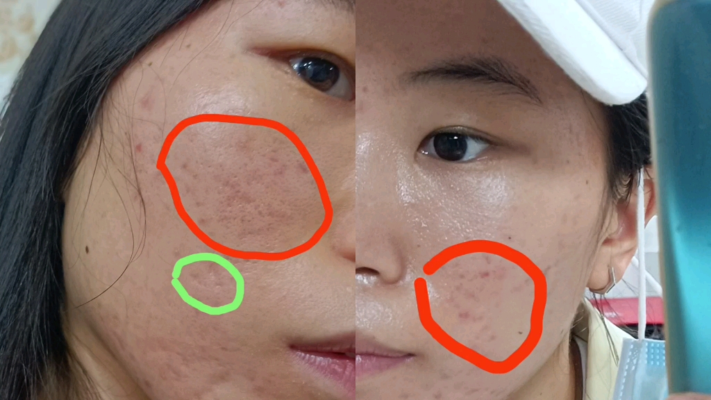 有的朋友想看的两次激光前后对比图