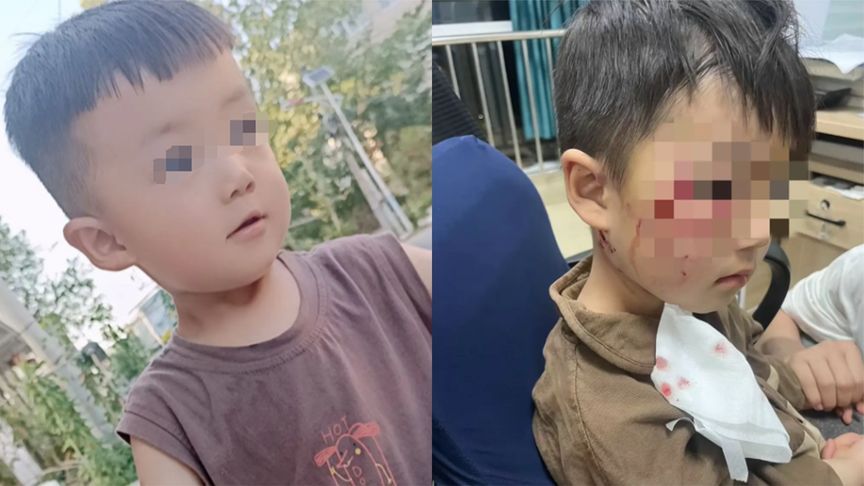 狂犬病疫苗无法保证不感染!3岁男童被狗咬伤离世,调查结果公布
