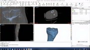 胫骨骨折内固定生物力学分析-mimics三维模型重建