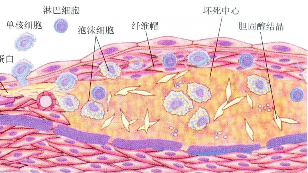 血栓形成,心梗、脑梗自然来!记住3种"化血栓"食物,要多吃!