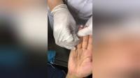 王合民刺血四缝放血治疗脾胃虚弱胃炎胃溃疡根治手法实操演示教学...