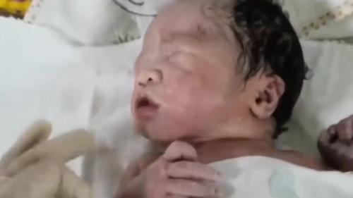 刚出生的婴儿一动不动,医生拼命的用手弹,宝宝一下就大哭了起来