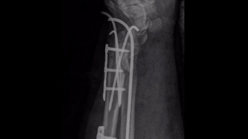 尺桡骨开放性粉碎性骨折,术后四个月骨折断端吸收不愈合