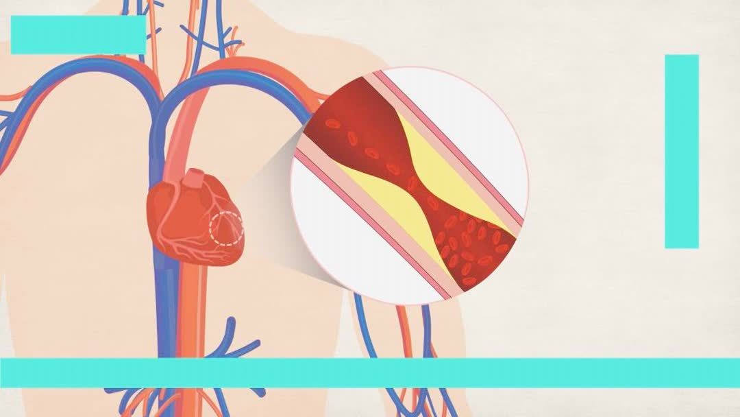 动脉硬化一般是怎样找上自己的?这几种高危因素你避开了几个?