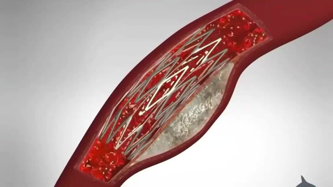 医学3D动画演示:经皮介入冠状动脉支架植入术过程