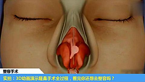 实拍: 3D动画演示隆鼻手术全过程, 看完你还想去整容吗?