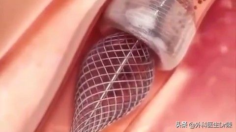3D医学动画:血栓取出术