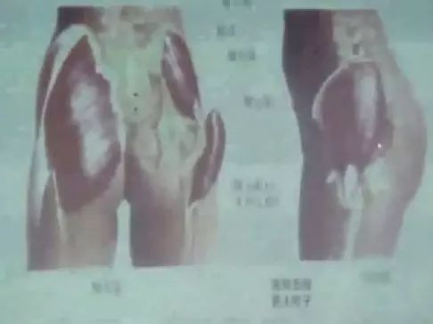 ...一手李建民--骨盆软组织损伤的诊断和治疗--中医针灸、正骨、推拿培训