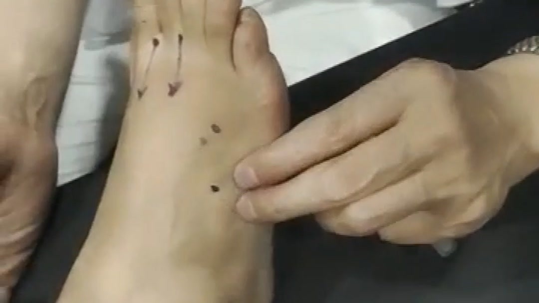 吴士杰无痛一针疗法 | 足六针操作教程