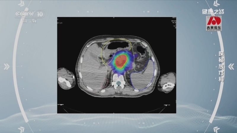 [健康之路]探秘放疗科 大剂量的放射线会不会导致正常组织癌变?
